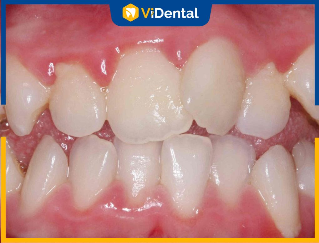 Giải Đáp: Niềng Răng Lệch Lạc Mất Bao Lâu Để Răng Đều Đẹp?