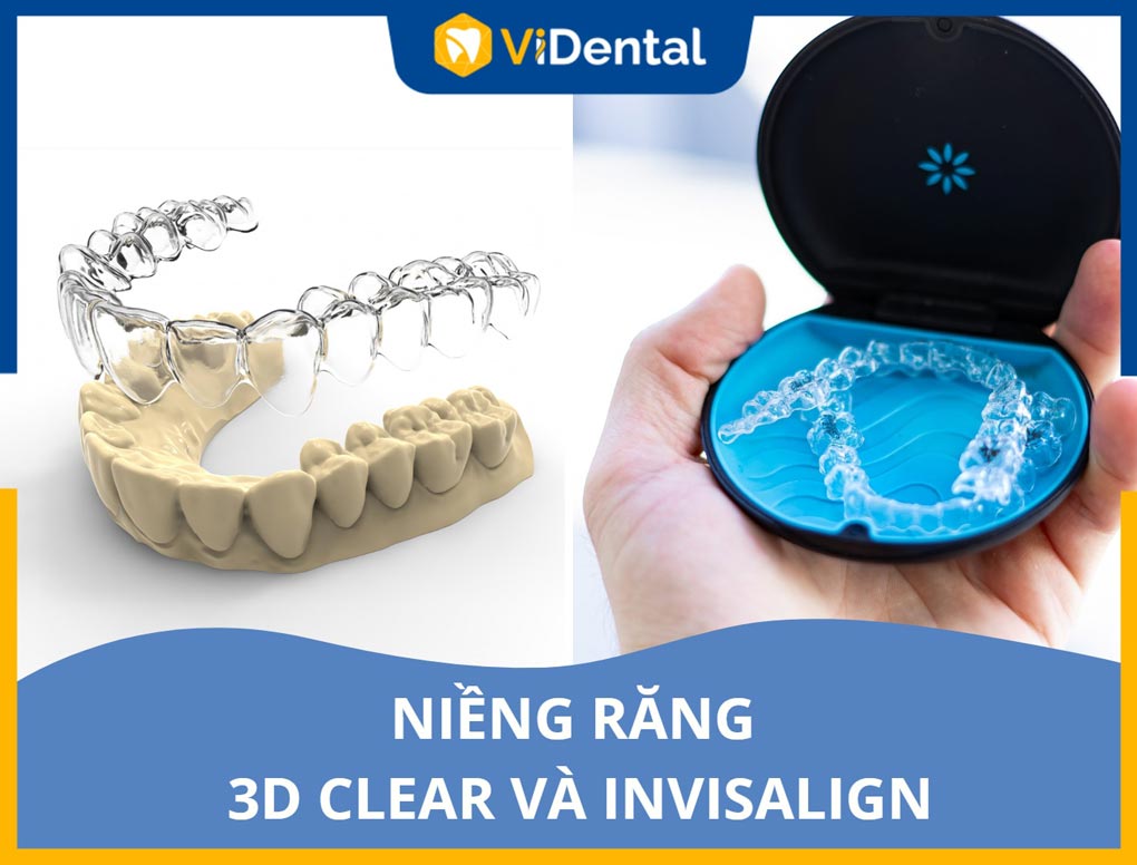 [So Sánh] Niềng Răng 3D Clear Và Invisalign